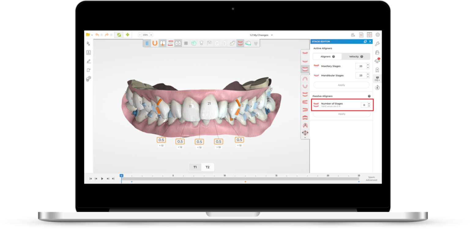 Ormco - Spark™ Releases - Latest Updates on Spark Aligners