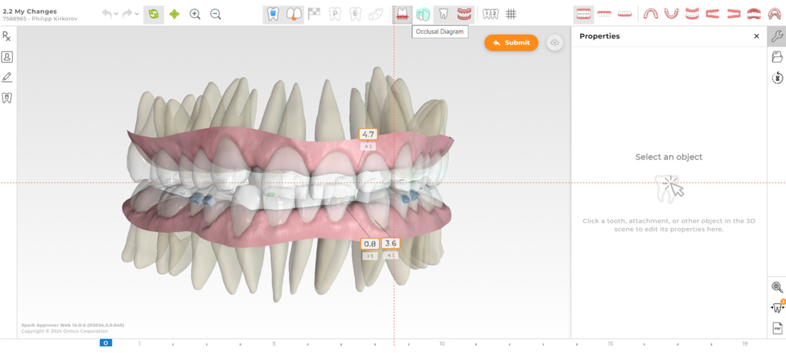 Ormco - Spark™ Releases - Latest Updates on Spark Aligners