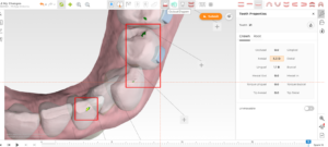 Ormco - Spark™ Releases - Latest Updates on Spark Aligners