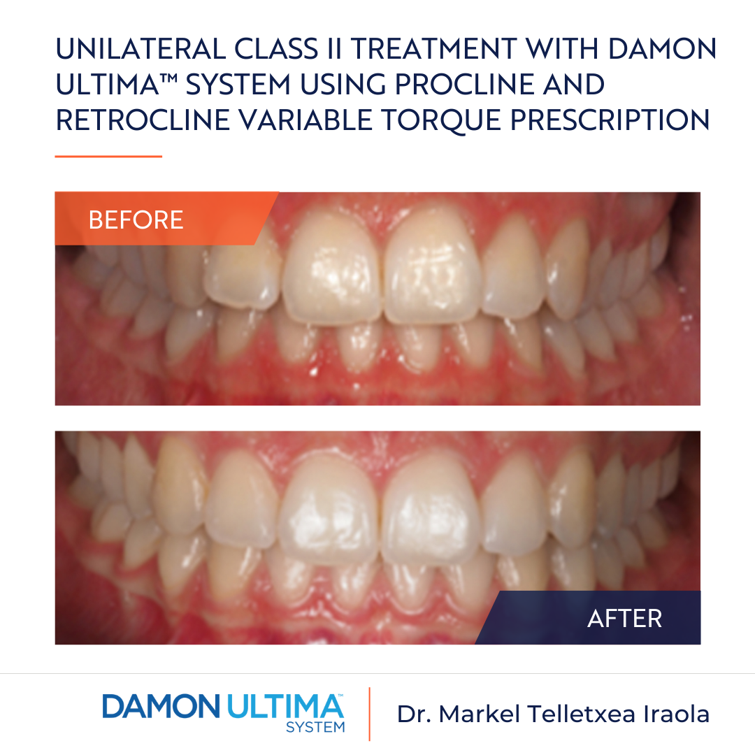 Unilateral Class Ii Treatment With Damon Ultima邃 System