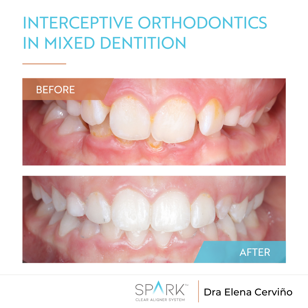 Spark: Interceptive orthodontics in mixed dentition - Ormco